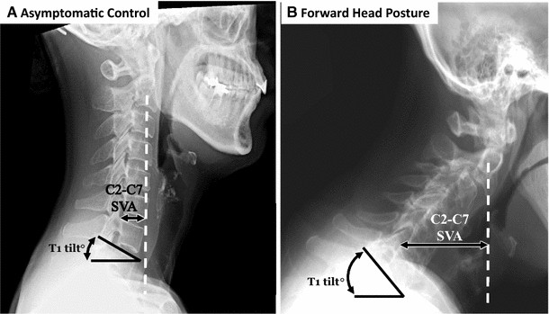 Dimensions of the cervical neural foramen in conditions of spinal ...