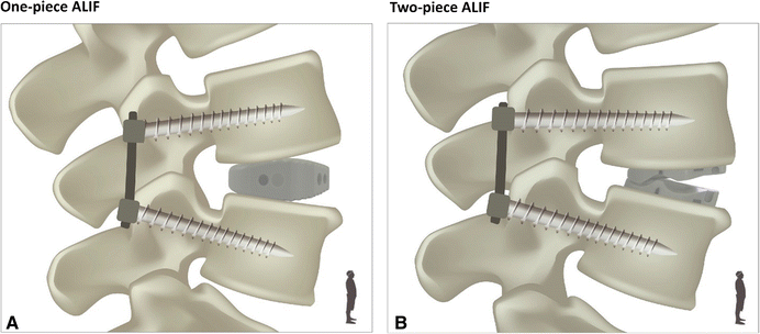 Two-piece ALIF cage optimizes the bone–implant interface in a 360 ...