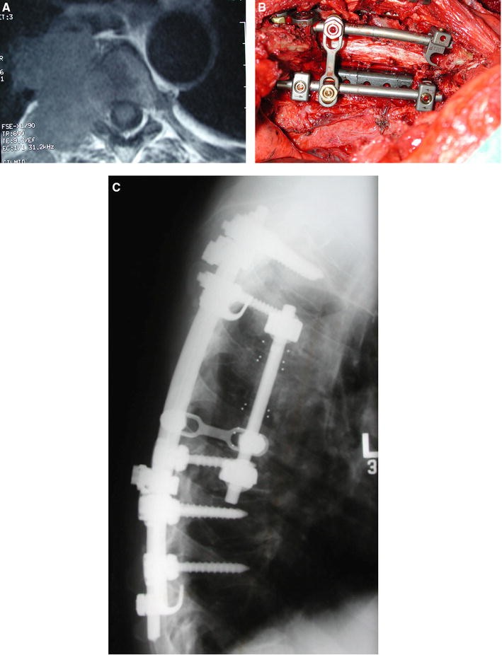 A novel muscle-sparing high thoracotomy for upper thoracic spine ...