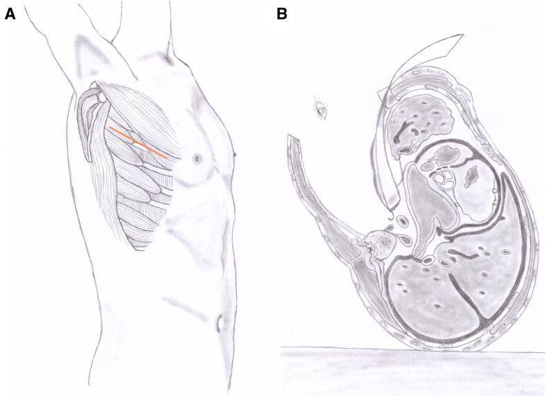 Right infraaxillary thoracotomy approach for upper thoracic vertebral ...