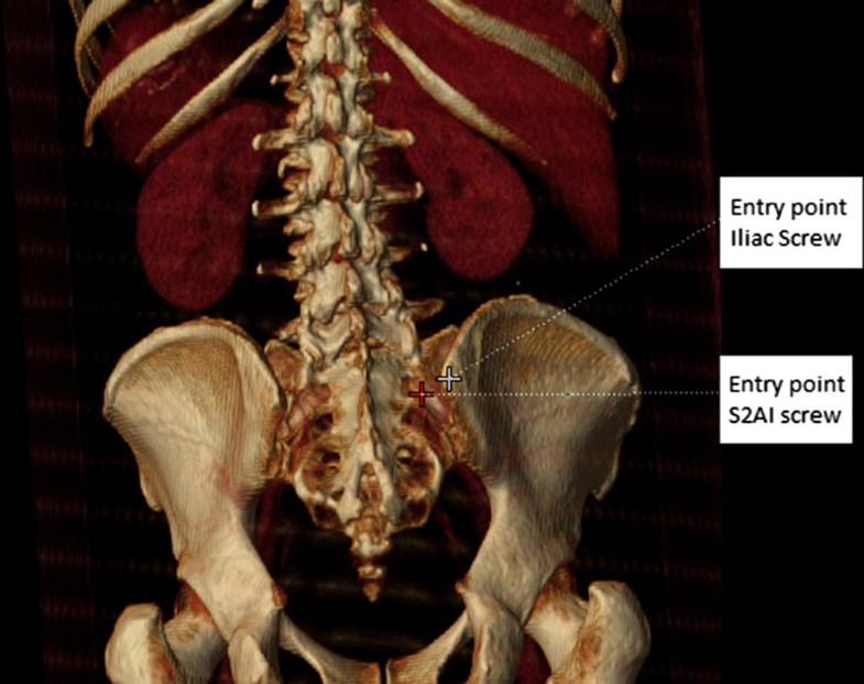 Comparative tomographic study of the S2-alar-iliac screw versus the ...