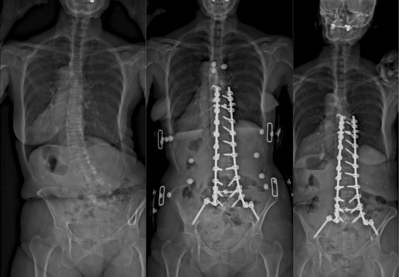 Classification of coronal imbalance in adult scoliosis and spine ...