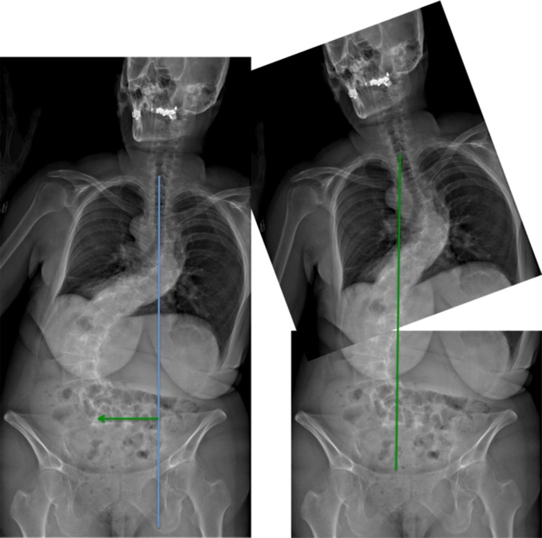 Classification of coronal imbalance in adult scoliosis and spine ...