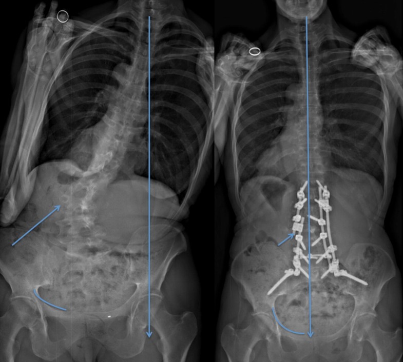 Classification of coronal imbalance in adult scoliosis and spine ...