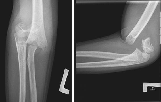 Evaluation and management of pulseless pink/pale hand syndrome ...