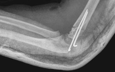 Evaluation and management of pulseless pink/pale hand syndrome ...