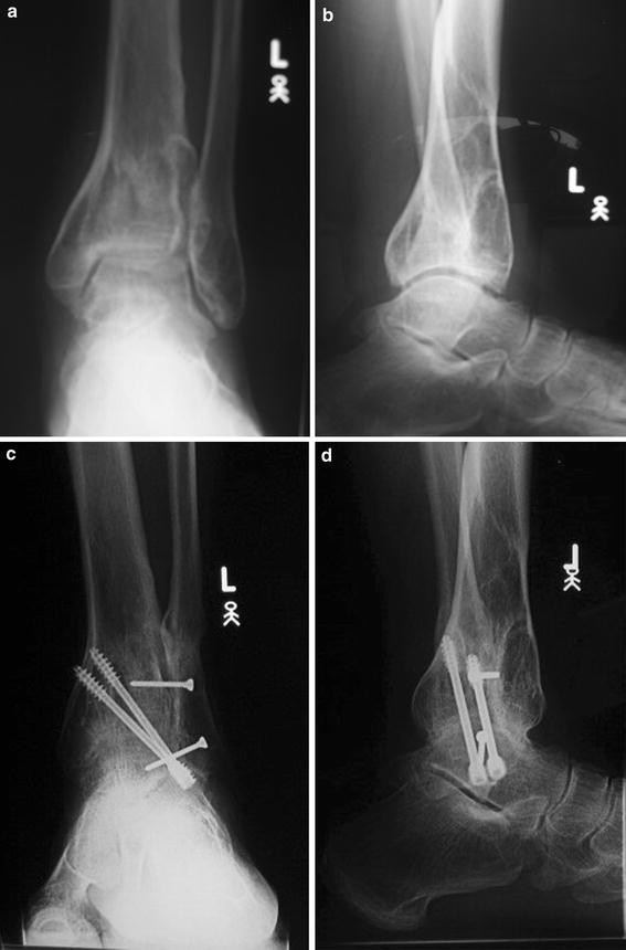 Ankle arthrodesis from lateral transfibular approach: analysis of ...