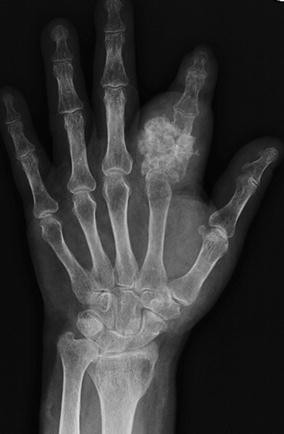 Tumors of the hand | SpringerLink