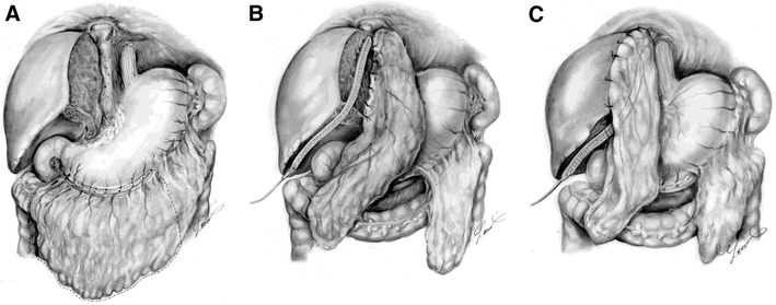 Omental flap wrapping with fixation to the cut surface of the liver for ...