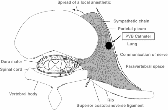 Paravertebral block via the surgical field versus epidural block for ...