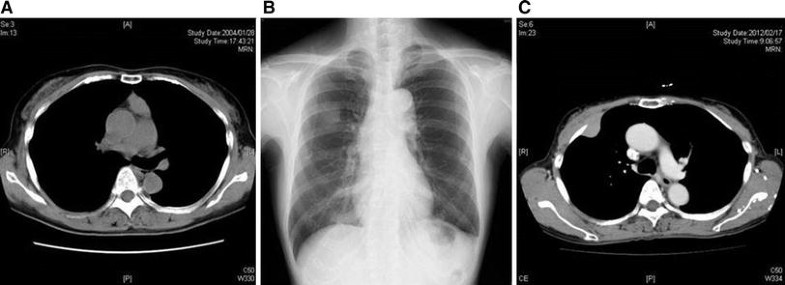 Port-site recurrence after complete resection of stage I thymoma by ...