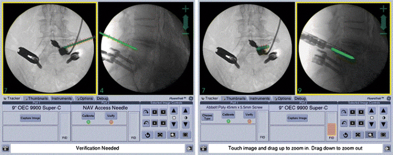 Minimally invasive percutaneous transpedicular screw fixation ...
