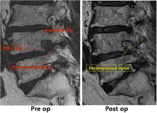 How I do it? Biportal endoscopic spinal surgery (BESS) for treatment of ...