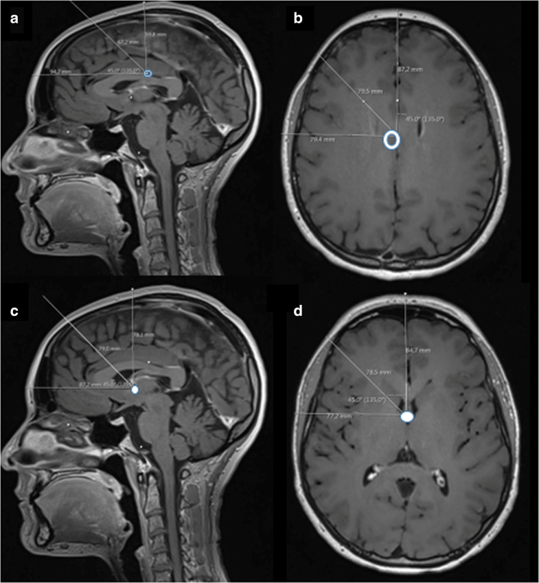 Best zero level for external ICP transducer | SpringerLink