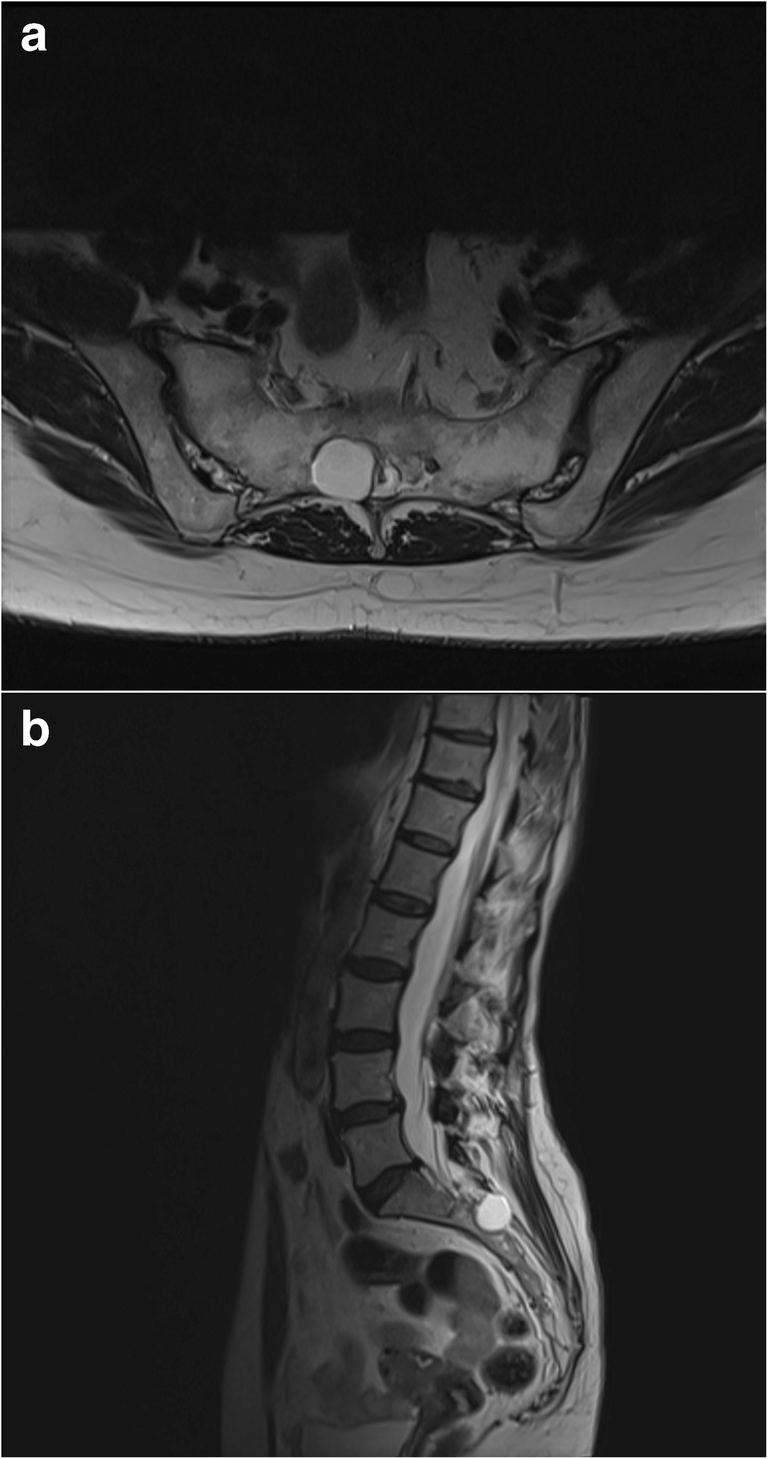Management of perineural (Tarlov) cysts: a population-based cohort ...