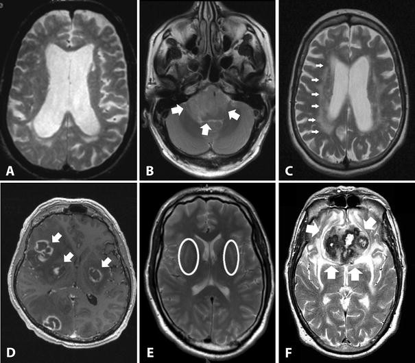 Magnetic resonance imaging for the diagnosis of Parkinson’s disease ...