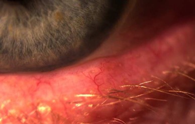 Interventionelle Therapie bei Dysfunktion der Meibom-Drüsen | SpringerLink