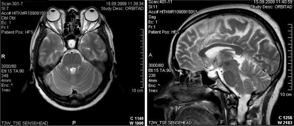 Patient with idiopathic intracranial hypertension with progressive ...