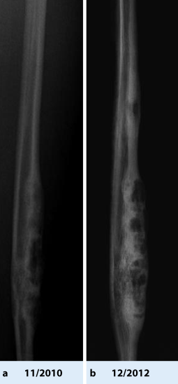 Entartungsrisiko von gutartigen Knochenläsionen | SpringerLink