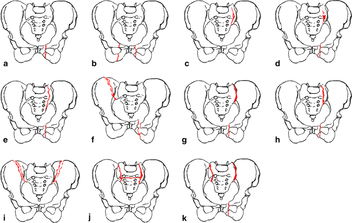 Clinical pathways for fragility fractures of the pelvic ring: personal ...
