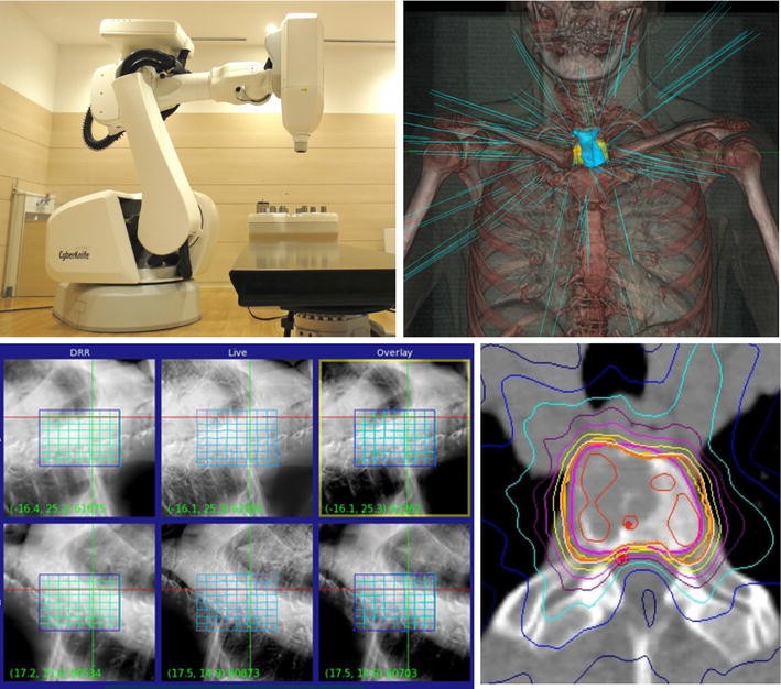 The current status and future of radiotherapy for spinal bone ...
