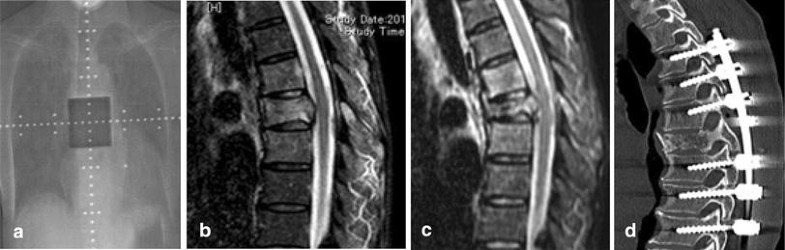 The current status and future of radiotherapy for spinal bone ...