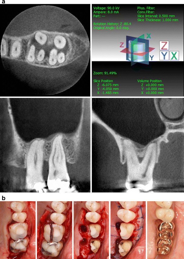 Periodontal surgery in furcation-involved maxillary molars revisited—an ...