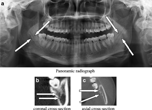 The clinical relevance of bifid and trifid mandibular canals | SpringerLink