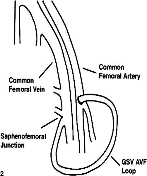 Saphenous Vein Loop to Femoral Artery Arteriovenous Fistula: A ...