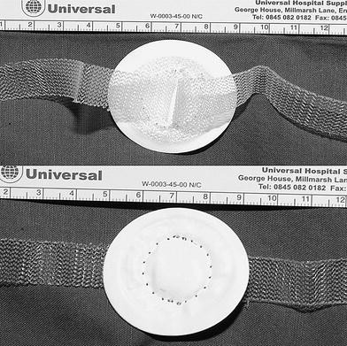 Intraperitoneal tension-free repair of small midline ventral abdominal ...