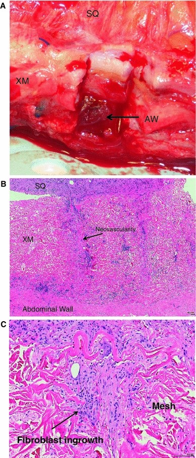 Onlay ventral hernia repairs using porcine non-cross-linked dermal ...
