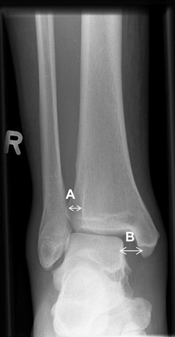 Sprunggelenkfrakturen | SpringerLink
