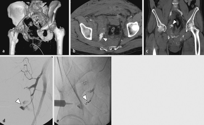 Verletzungen von Becken und Azetabulum | SpringerLink