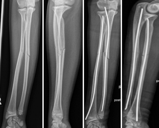 Elastisch stabile intramedulläre Nagelung | SpringerLink