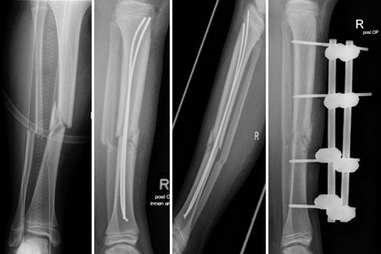 Elastisch stabile intramedulläre Nagelung | SpringerLink
