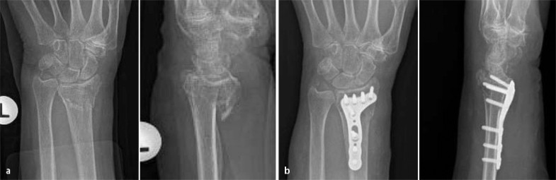 Distale Radiusfraktur | SpringerLink