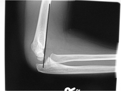 Suprakondyläre und subkapitale Humerusfrakturen | SpringerLink