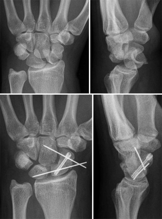 Knöcherne Verletzungen der Handwurzel | SpringerLink