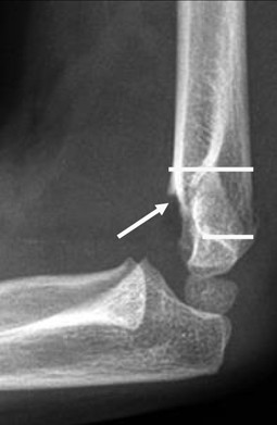 Sturz auf den Ellenbogen | SpringerLink