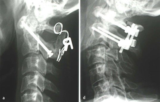Behandlung der Atlas- und Dens-axis-Frakturen | SpringerLink