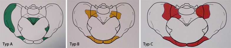 Beckenringinstabilitäten | SpringerLink