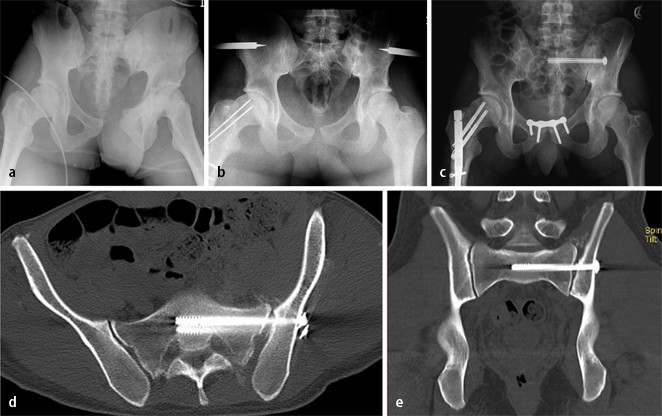 Beckenringinstabilitäten | SpringerLink