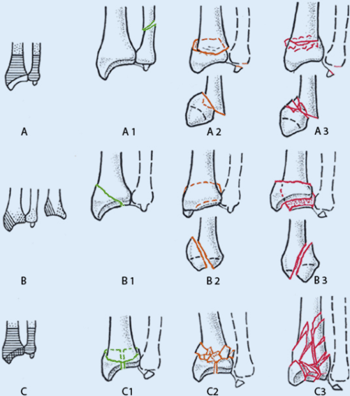 Distale Radiusfraktur | SpringerLink