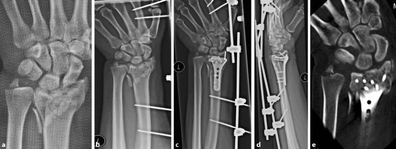 Distale Radiusfraktur | SpringerLink