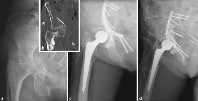 Stellenwert der Endoprothetik nach Acetabulumfraktur | SpringerLink