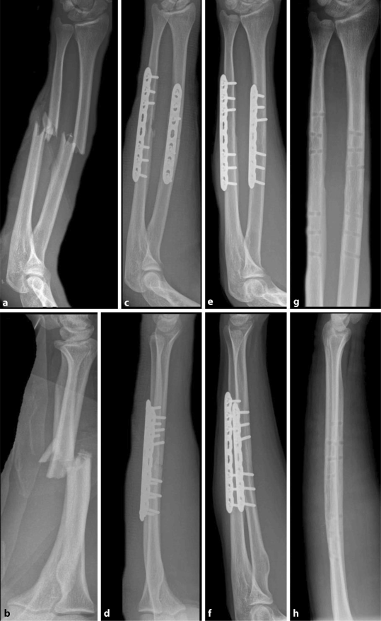 Was ist der Standard in der Versorgung der Unterarmschaftfraktur ...