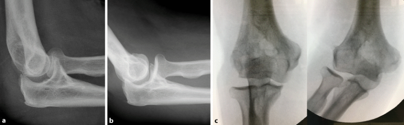 Sekundäre Bandrekonstruktion am Ellenbogen | SpringerLink