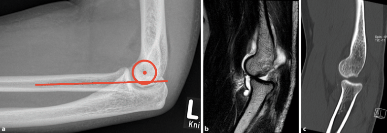 Sekundäre Bandrekonstruktion am Ellenbogen | SpringerLink