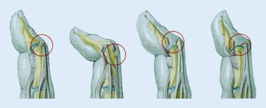 Spezielle Verletzungen der Strecksehnen an der Hand | SpringerLink
