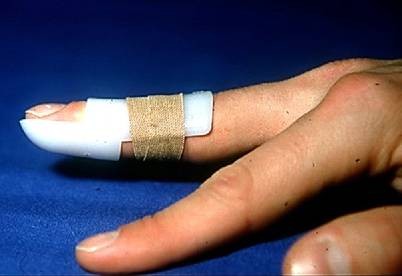 Spezielle Verletzungen der Strecksehnen an der Hand | SpringerLink